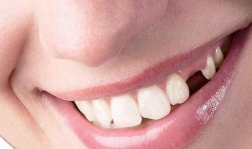 Here are the 3 Best Dental Treatments to Replace Your Missing Tooth ...